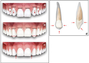 Missing Maxillary Lateral Incisors and Considerations for Treatment Plans