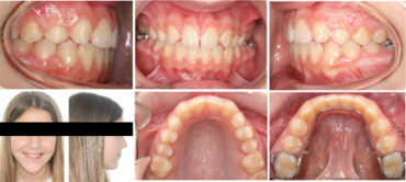 Missing Maxillary Lateral Incisors and Considerations for Treatment Plans