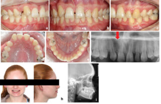 Missing Maxillary Lateral Incisors and Considerations for Treatment Plans