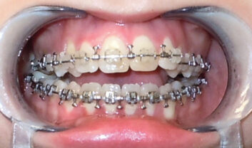 Presurgical Maxillary Segmented Orthodontics: A Simple Concept to ...