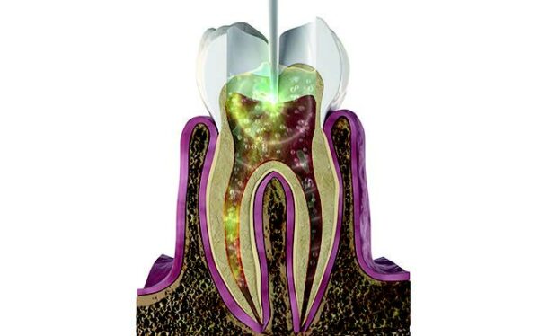 SWEEPS Modality Opens a New Era: Digitally Pulsed Lasers, Endodontics ...