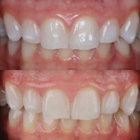 Conservative Esthetic Management of White Spot Fluorosis Lesions: A ...