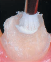 Demystifying Cementation: Master the Vital Principles Every Dentist ...