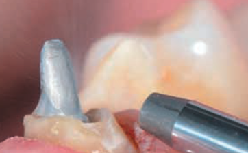 Demystifying Cementation: Master the Vital Principles Every Dentist ...