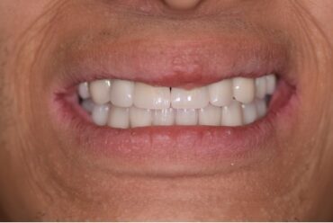 Treatment Options for Replacement of Congenitally Missing Teeth