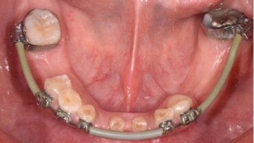 Treatment Options for Replacement of Congenitally Missing Teeth