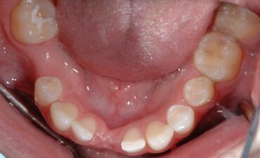 Treatment Options for Replacement of Congenitally Missing Teeth