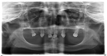 Treatment Options for Replacement of Congenitally Missing Teeth