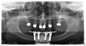 Treatment Options for Replacement of Congenitally Missing Teeth