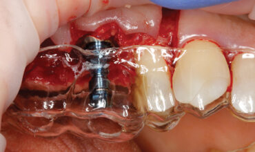 Immediate Implant Placement in the Maxillary Molar with Concomitant ...