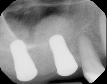 Immediate Implant Placement in the Maxillary Molar with Concomitant ...
