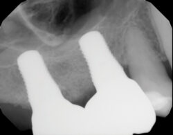 Immediate Implant Placement in the Maxillary Molar with Concomitant ...