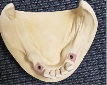 Implant Supported Removable Partial Denture: The Why and the How