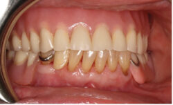Implant Supported Removable Partial Denture: The Why and the How
