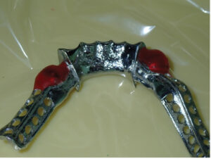 Implant Supported Removable Partial Denture: The Why and the How