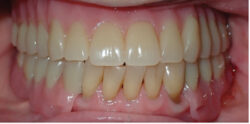 Implant Supported Removable Partial Denture: The Why and the How