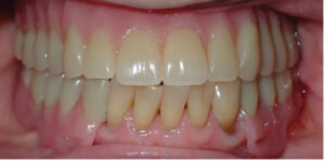 Implant Supported Removable Partial Denture: The Why and the How