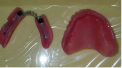 Implant Supported Removable Partial Denture: The Why and the How