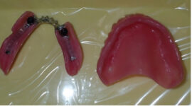 Implant Supported Removable Partial Denture: The Why and the How