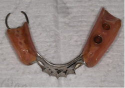 Implant Supported Removable Partial Denture: The Why and the How