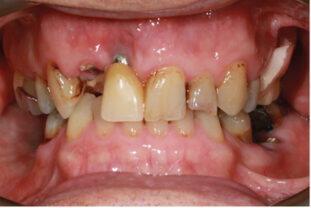 Implant Supported Removable Partial Denture: The Why and the How