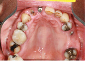 Implant Supported Removable Partial Denture: The Why and the How