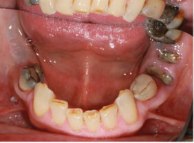 Implant Supported Removable Partial Denture: The Why and the How