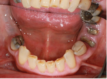 Implant Supported Removable Partial Denture: The Why and the How