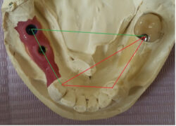 Implant Supported Removable Partial Denture: The Why and the How