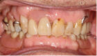 Implant Supported Removable Partial Denture: The Why and the How