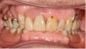 Implant Supported Removable Partial Denture: The Why and the How