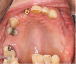 Implant Supported Removable Partial Denture: The Why and the How