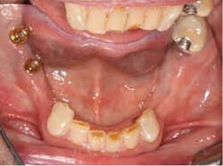 Implant Supported Removable Partial Denture: The Why and the How