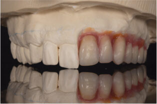 Digital Planning and Restoration of a Fully Guided Maxillary Implant ...