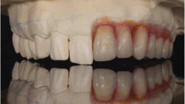Digital Planning and Restoration of a Fully Guided Maxillary Implant ...