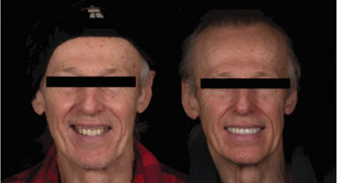 Digital Planning and Restoration of a Fully Guided Maxillary Implant ...