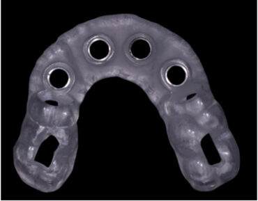 Digital Planning and Restoration of a Fully Guided Maxillary Implant ...