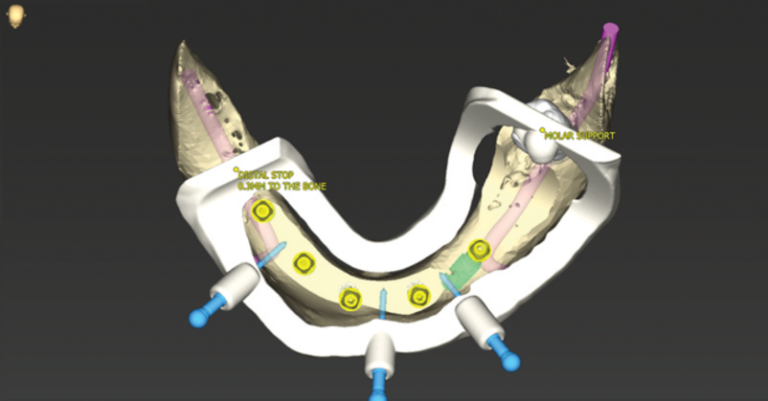 Complete Digital Workflow for Mandibular Full-arch Implant Placement ...