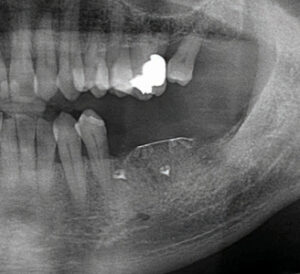 Ridge Augmentation Using a Non-resorbable Ti-reinforced Membrane for ...