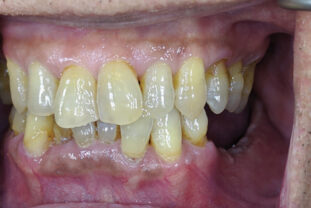 Ridge Augmentation Using a Non-resorbable Ti-reinforced Membrane for ...