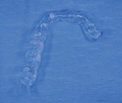 Ridge Augmentation Using a Non-resorbable Ti-reinforced Membrane for ...