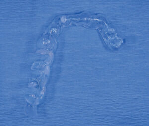 Ridge Augmentation Using a Non-resorbable Ti-reinforced Membrane for ...