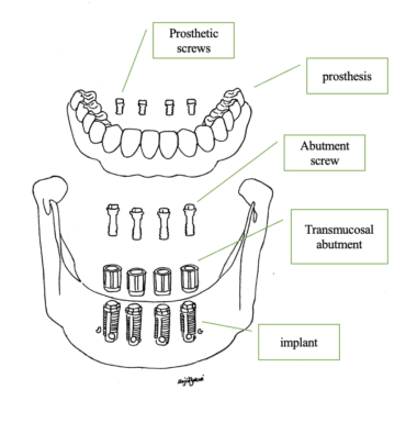 Management of a Dislodged Implant-supported Full-arch Bridge Due to ...