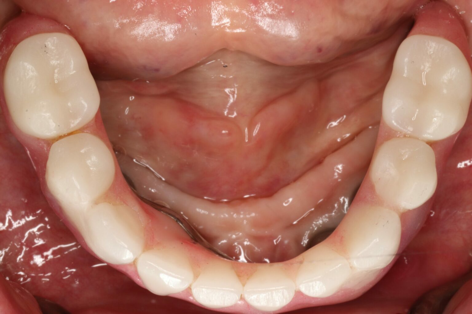 Management of a Dislodged Implant-supported Full-arch Bridge Due to ...