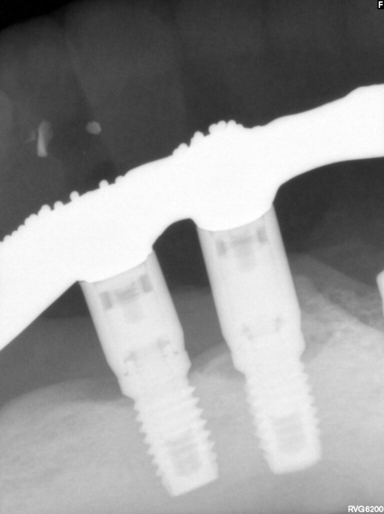 Management of a Dislodged Implant-supported Full-arch Bridge Due to ...