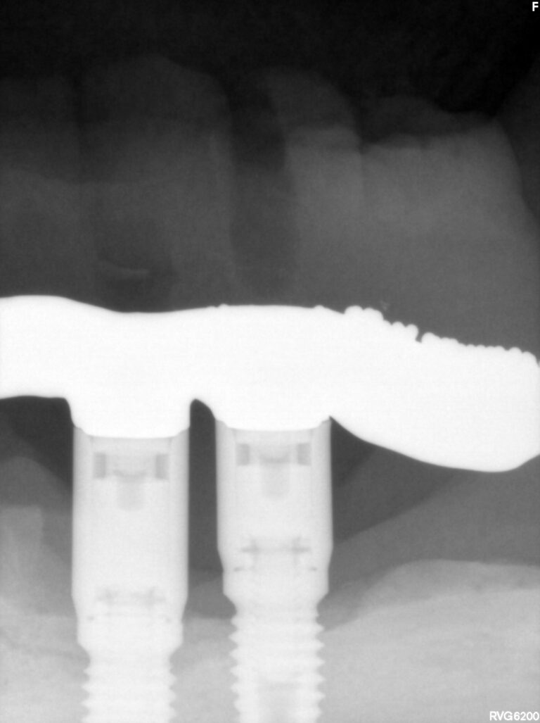 Management of a Dislodged Implant-supported Full-arch Bridge Due to ...