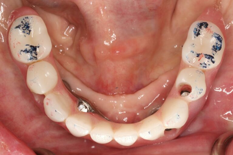 Management of a Dislodged Implant-supported Full-arch Bridge Due to ...