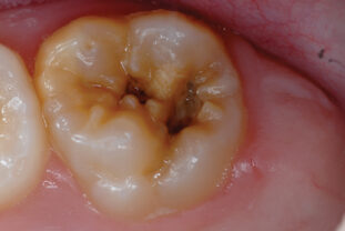 Medical Management of Dental Caries: “Be a Knife Doctor and a Pill Doctor”