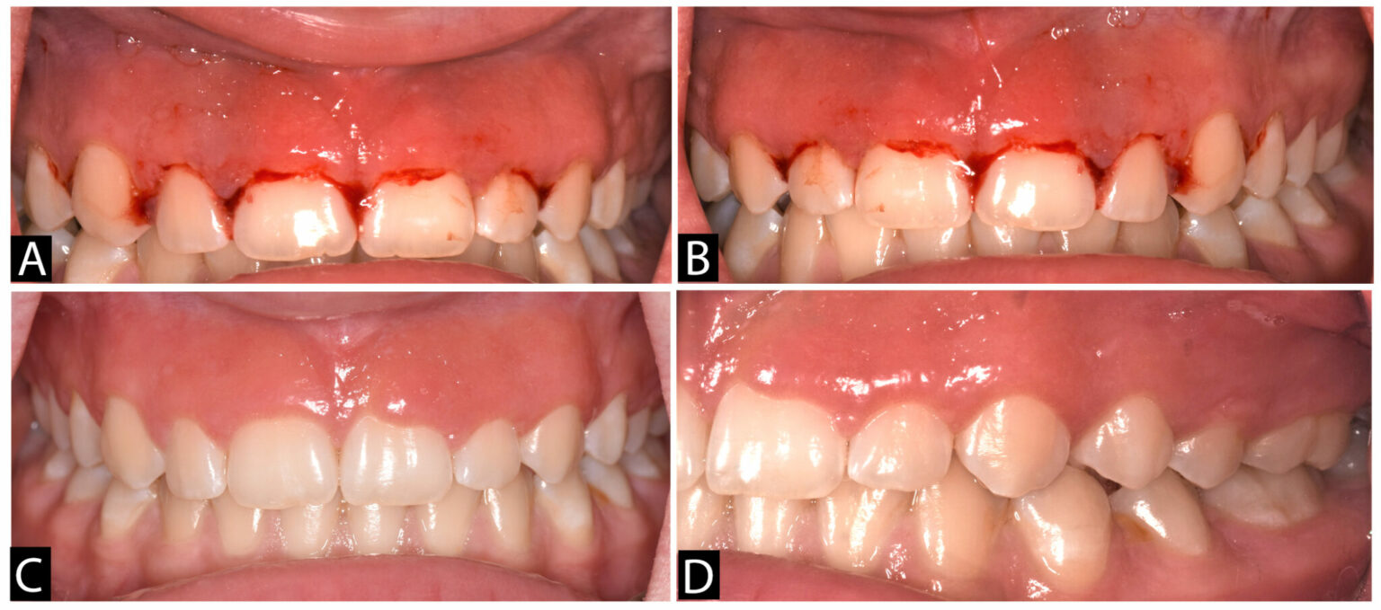 Esthetic Management of Patient with Orofacial Granulomatosis
