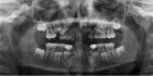 Complex-compound Odontoma: A Case Report - Oral Health Group